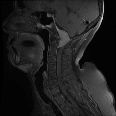 Radiology Cases: CCJ Meningioma