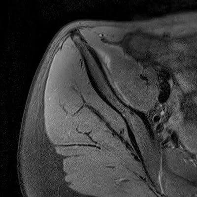 Radiology Cases: Iliacus Muscle Contusion with Submuscular Haemorrhage