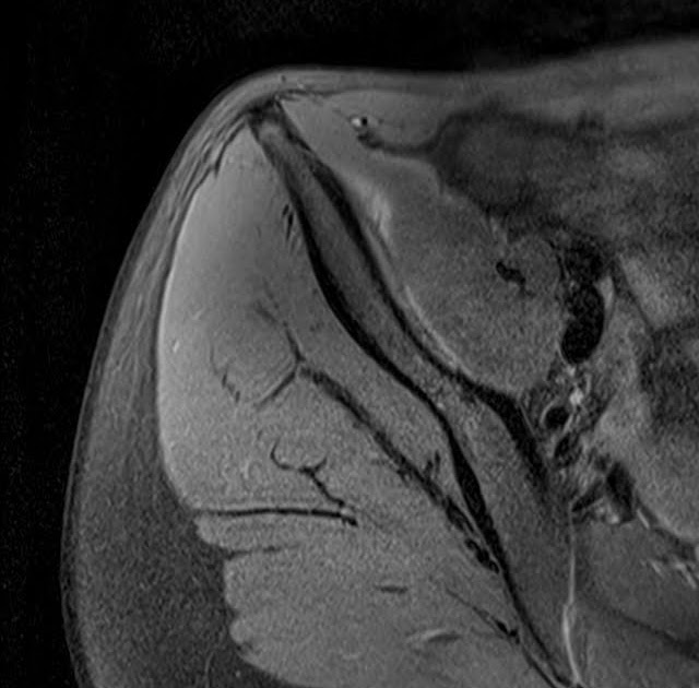 Radiology Cases: Iliacus Muscle Contusion with Submuscular Haemorrhage