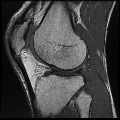 Radiology Cases: Acute Patella Chondral Contusion