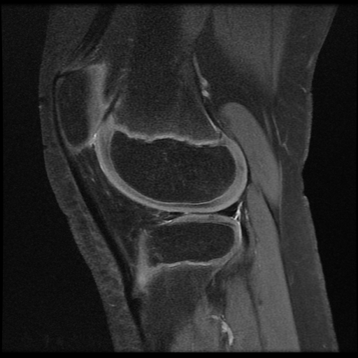 Radiology Cases: Patella Alta and Lateral Subluxation