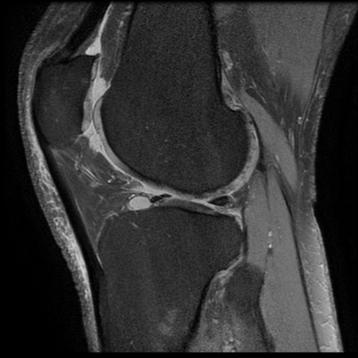 Radiology Cases: Chondrocalcinosis