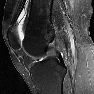 Radiology Cases: Partial ACL Tear