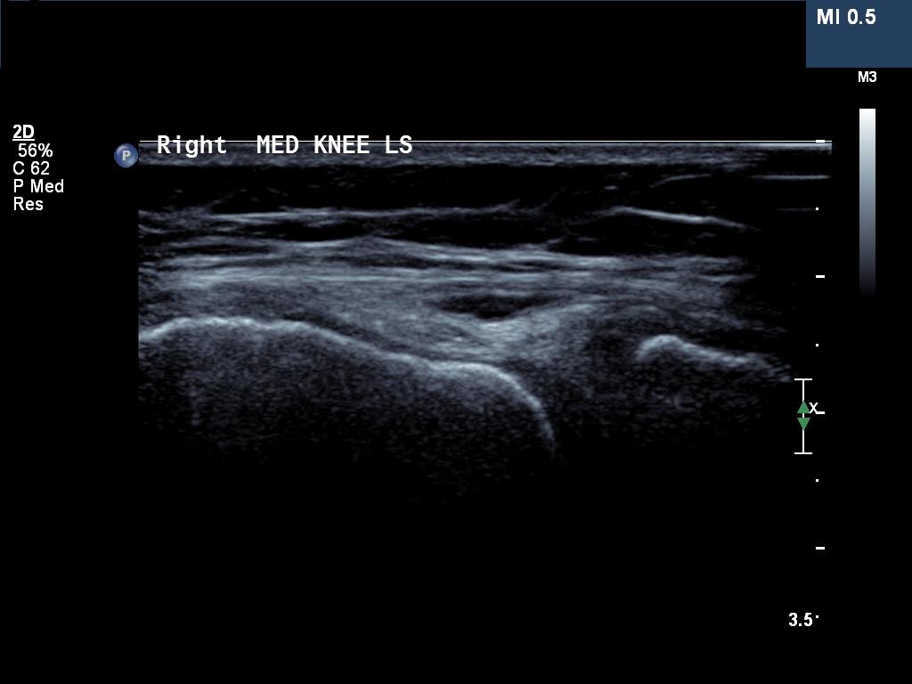 Radiology Cases: Voshell's Bursitis