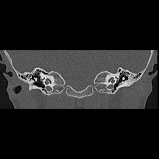 Radiology Cases: Mondini malformation