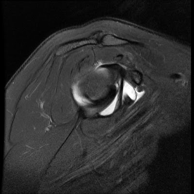 Radiology Cases: Anterosuperior Labral Tear with Paralabral Cyst