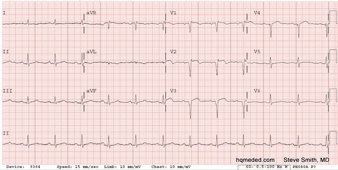 Dr. Smith's ECG Blog: Classic LV aneurysm (persistent ST elevation ...