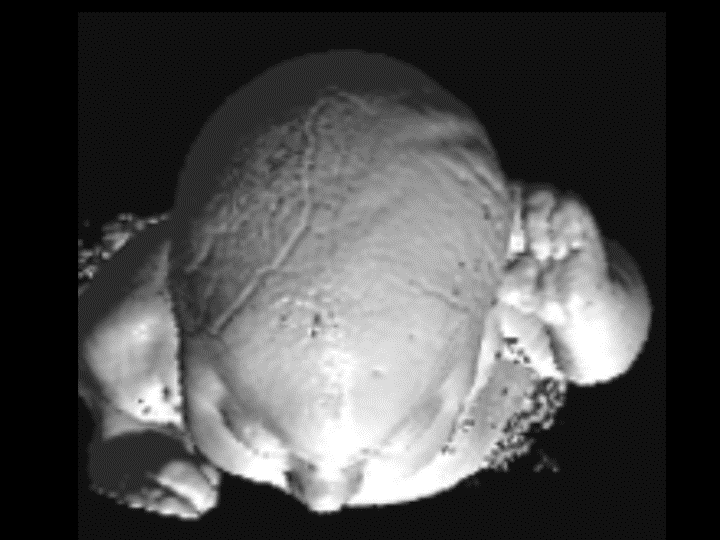 My Radiology World: "Trigonocephaly"