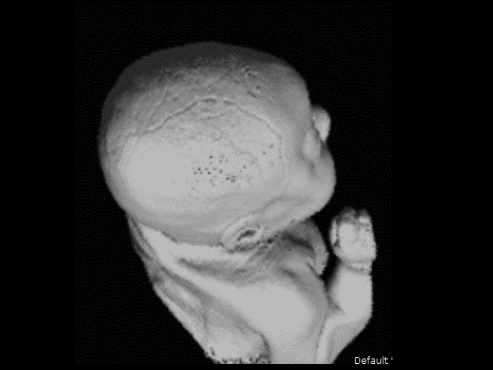 My Radiology World: "Trigonocephaly"
