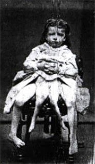 Destylou - Rarezas: Myrtle Corbin - Mujer con cuatro piernas