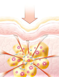 Subincision - JungleKey.fr Image #200