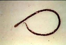 Parasite of the Day: November 1 - Onchocerca volvulus