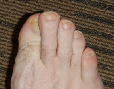 Can You Cross Your Toes?