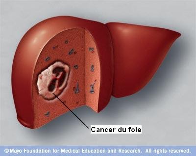 Tout savoir sur les cancers: Quelques informations sur le cancer du foie