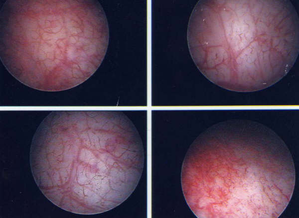 Claves de Salud: Remedios caseros para la cistitis