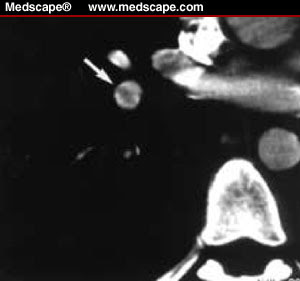 CT_physics_2009: ARTIFACTS IN SPIRAL CT