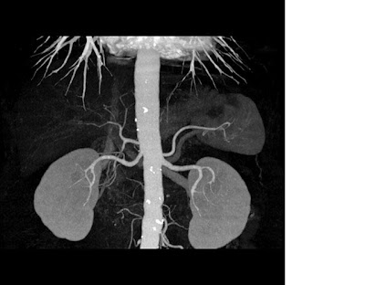 CT_physics_2009: Maximum Intensity Projection