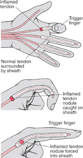 Internal Medicine: Trigger Finger (Stenosing Tenosynovitis)