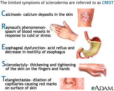 Systemic Sclerosis (scleroderma) - MDNotes