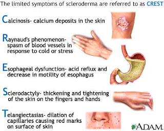 Systemic Sclerosis (scleroderma) - MDNotes