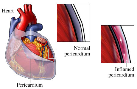 Acute Pericarditis - 2 - MDNotes