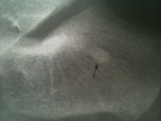 Advanced Foot & Ankle Center: Calcaneal (heel bone) Cyst & Tumors