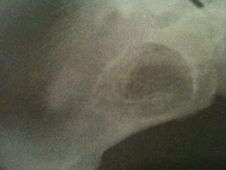 Advanced Foot & Ankle Center: Calcaneal (heel bone) Cyst & Tumors