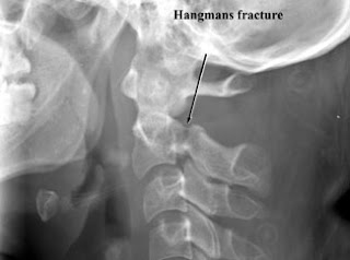 International University: Hangman's Fracture