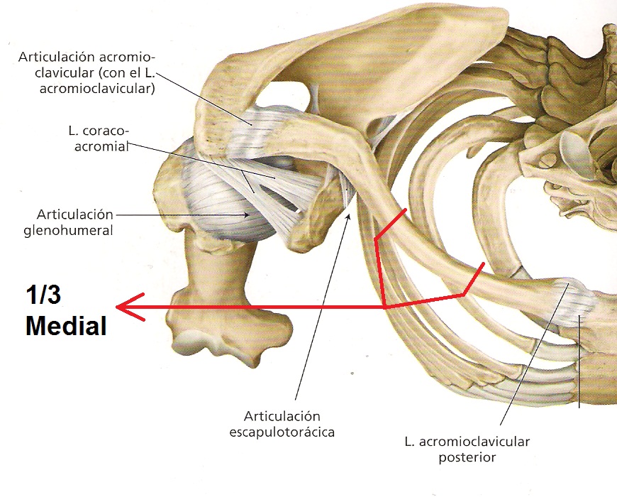 Fractura de Clavicula