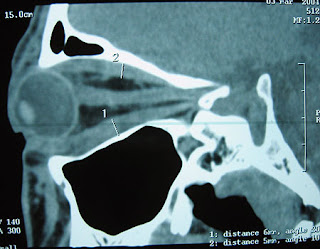 a little bit of medicine: Boala Basedow-Graves-Perry