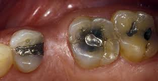 para toda la vida...: Obturando con AMALGAMA de Plata...Pros y Contras...