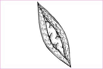 Nurse Base: RECOGNIZING DEHISCENCE AND EVISCERATION