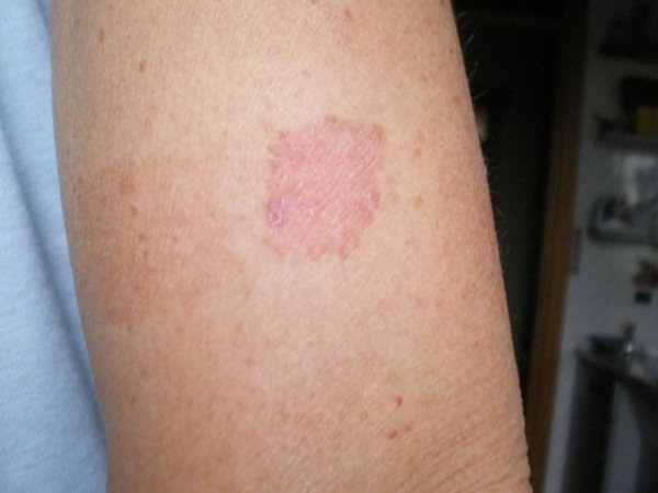 Elisa Martinelli La pelle tra salute e benessere: CARCINOMA ...