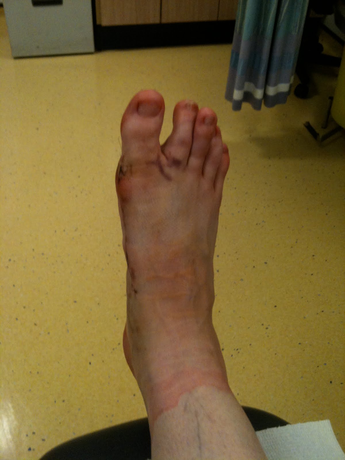 Everyday Rainbows: Post-op Bunion operation picture (look away if ...
