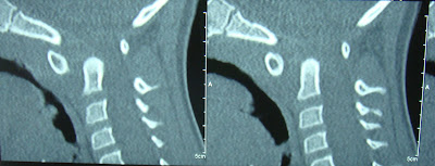 My Backbone: Atlanto axial instability in Down syndrome
