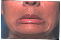 Skin Care Without Cosmetic Surgery: Botox Therapy: Anatomy of the Face