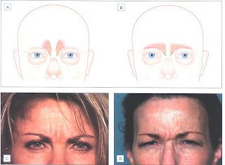 Skin Care Without Cosmetic Surgery: Botox Therapy: Anatomy of the Face