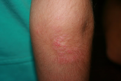 Madeline's JDM Story: Updated pics of Madeline's JDM rash