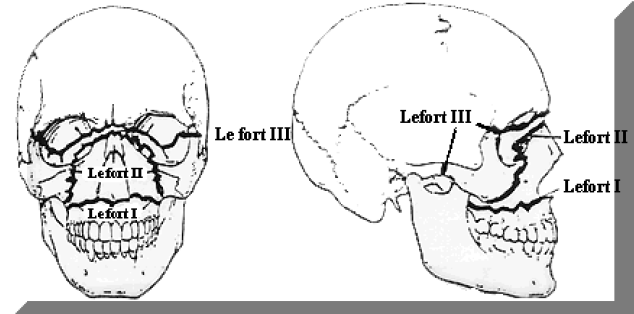 Dra. Medrigal: FRACTURAS LE FORT