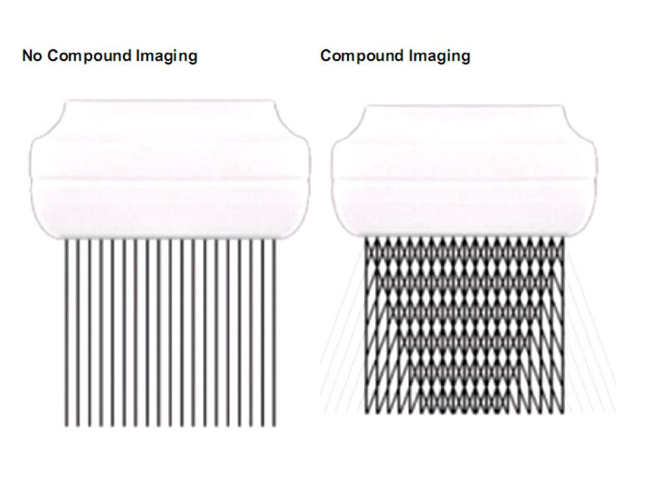 BÀI SOẠN VỀ SIÊU ÂM CHẨN ĐOÁN: SIÊU ÂM ĐA HƯỚNG / Spatial Compound ...