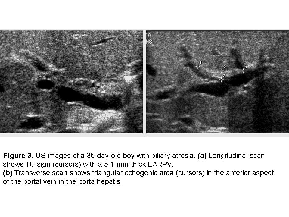 BÀI SOẠN VỀ SIÊU ÂM CHẨN ĐOÁN: TEO ĐƯỜNG MẬT và SIÊU ÂM CHẨN ĐOÁN