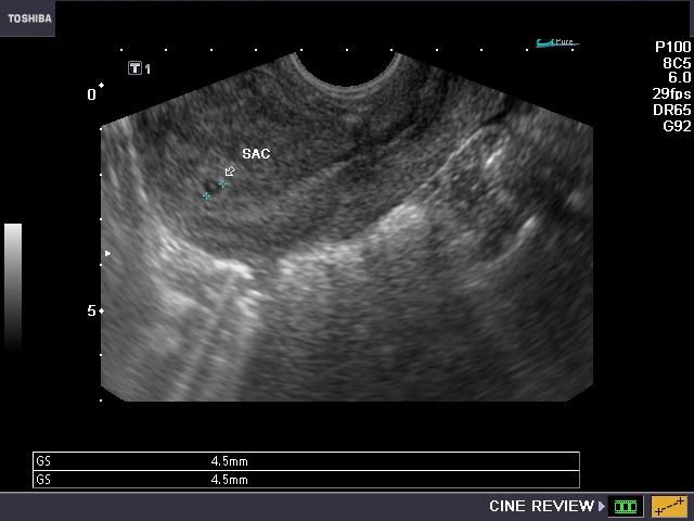 cochinblogs: Early pregnancy with Nabothian cyst