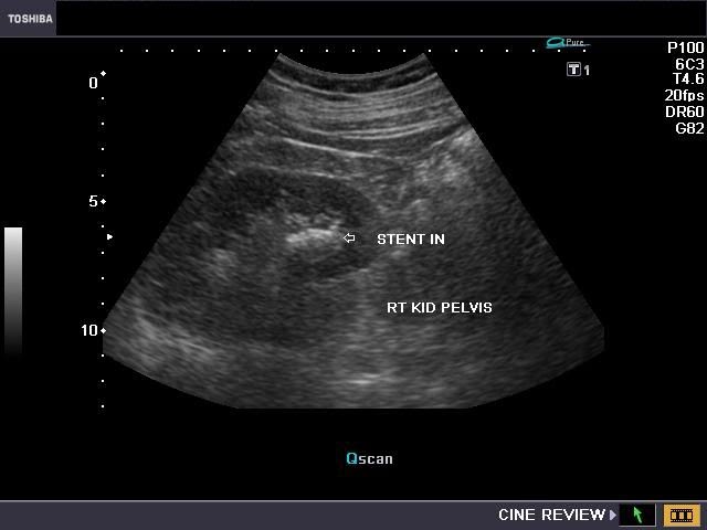 cochinblogs: Ultrasound imaging of Ureteral stent: