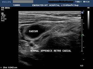 cochinblogs: Ultrasound images of retrocaecal appendix