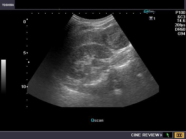 cochinblogs: An interesting case of mass in Riedel's lobe of liver