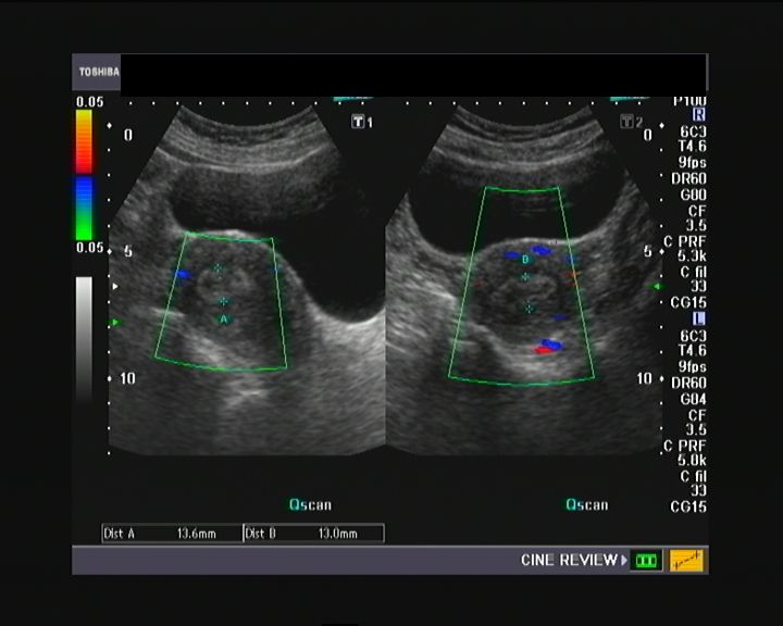 Ultrasound And Color Doppler Videos Multiple Nabothian Cysts Of The Cervix