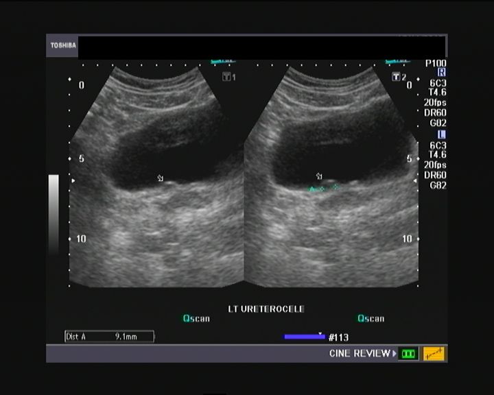 Ureterocele Ultrasound EPOS™