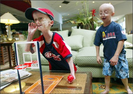 Enfermedades poco comunes: Síndrome de Hutchinson-Gilford (Progeria)