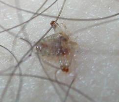 MISS PARASITOS: Ladillas