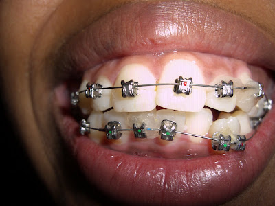 Train Track Journey: Braces from Consult to Day 2 Journey